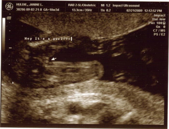 Different Types of Sonograms During Pregnancy - WeHaveKids