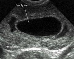 Blighted Ovum and Miscarriage - WeHaveKids