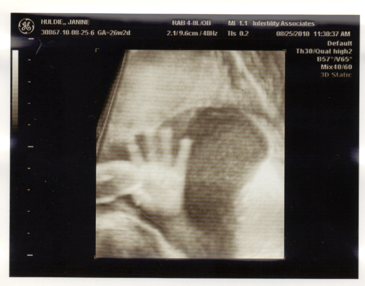 Different Types of Sonograms During Pregnancy - WeHaveKids